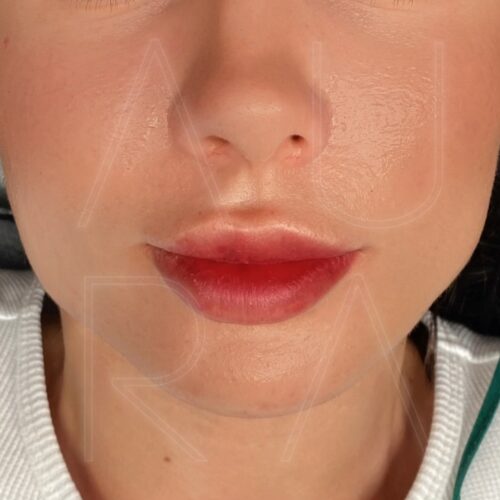 Cosmetic Lip Tattoo Melbourne | Lip Color & Liner | Aura Cosmetic